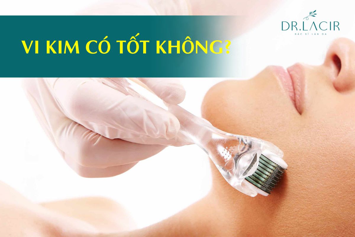 Vi kim có tốt không? Có nên sử dụng phương pháp vi kim làm đẹp – Dr Lacir